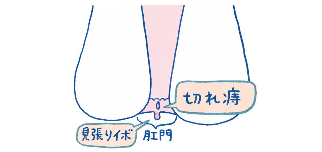 【実は「痔」によくない5つの習慣】種類や対策を肛門科専門医が解説！ | LEE